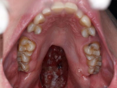 Hard palate perforation in cocaine abusers: a systematic review ...