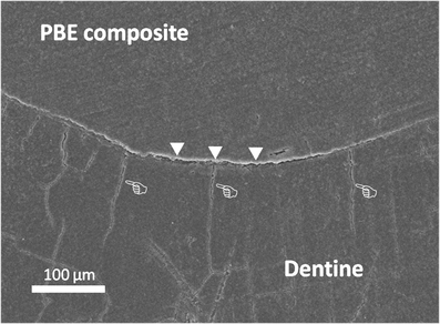 Effect of proximal box elevation with resin composite on marginal ...