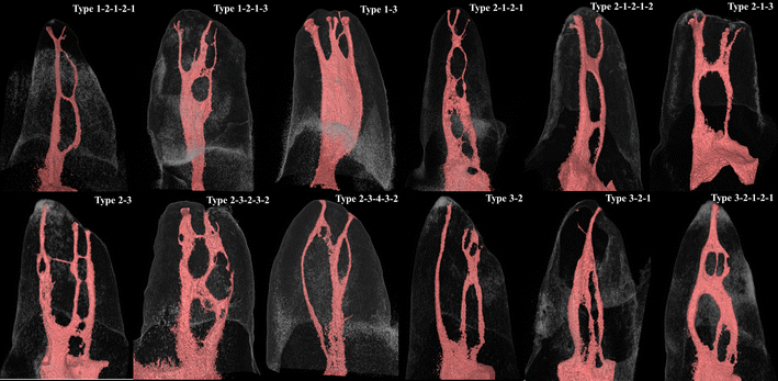 A micro-computed tomography study of canal configuration of multiple ...