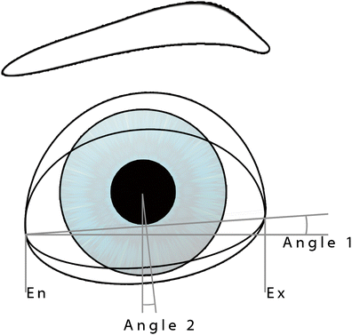 Cheek rotation flap reconstruction—an anthropometric appraisal of ...
