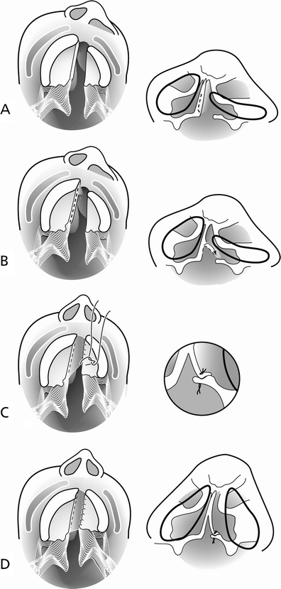 Early hard palate closure using a vomer flap in unilateral cleft lip ...