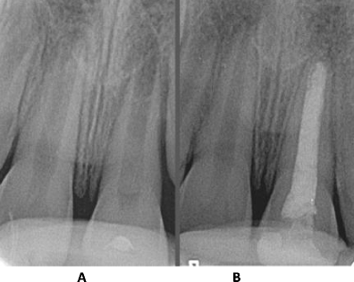 MTA versus Ca(OH)2 in apexification of non-vital immature permanent ...