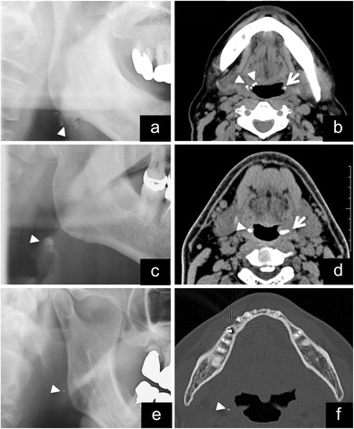 Prevalence and imaging characteristics of palatine tonsilloliths ...