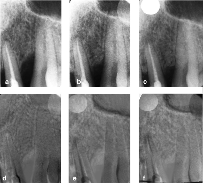 Treatment of intrabony defects with modified perforated membranes in ...
