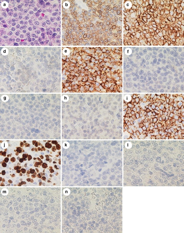 CD56-positive adult T-cell leukemia/lymphoma: a case report and a ...