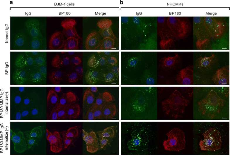 Anti-BP180-type mucous membrane pemphigoid immunoglobulin G shows ...