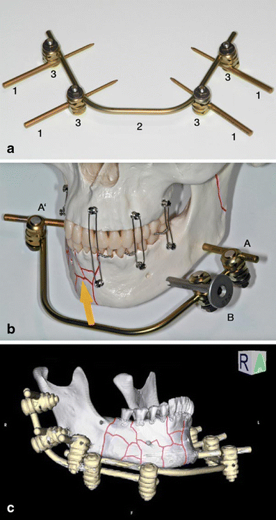 External pin fixation for stabilization of the mandible—comeback of a ...