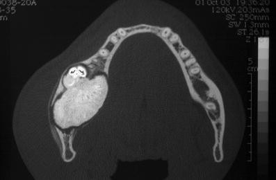 Two-stage surgical removal of large complex odontoma | SpringerLink