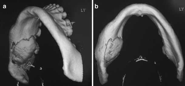 Two-stage surgical removal of large complex odontoma | SpringerLink