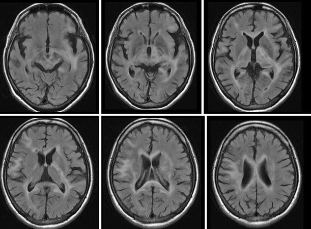 Lymphomatosis cerebri: clinical characteristics, neuroimaging, and ...