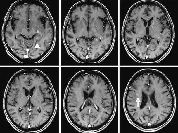 Lymphomatosis cerebri: clinical characteristics, neuroimaging, and ...