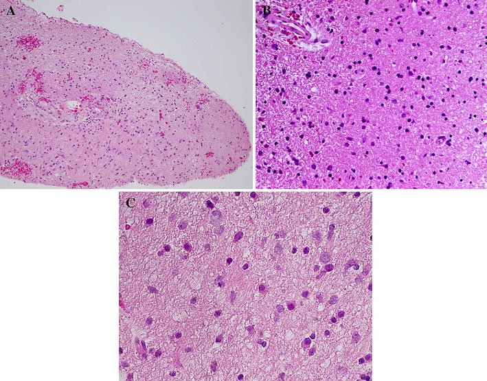 Lymphomatosis cerebri: clinical characteristics, neuroimaging, and ...