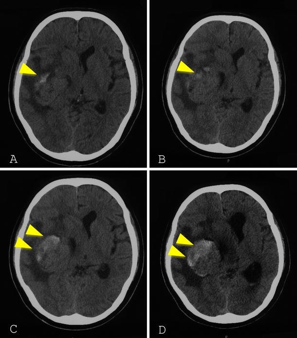 Supratentorial extraventricular anaplastic ependymoma in an adult with ...