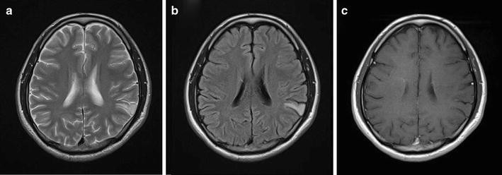 Multinodular and vacuolating neuronal tumor of the cerebrum | SpringerLink