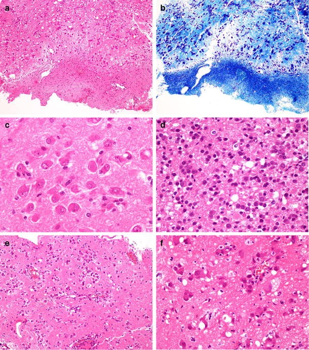 Multinodular and vacuolating neuronal tumor of the cerebrum | SpringerLink