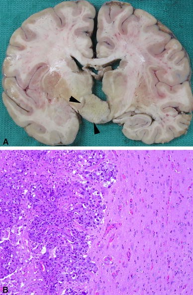 Brain metastasis: clinical characteristics, pathological findings and ...