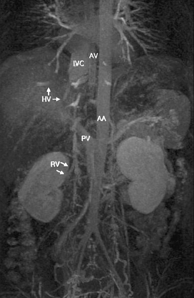 Deep Venous Thrombosis Caused by Congenital Absence of Inferior Vena ...