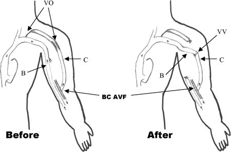 Venovenostomy for Outflow Venous Obstruction in Patients with Upper ...