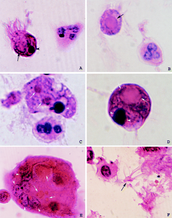 Pathology of Human Metapneumovirus Infection: Insights into the ...