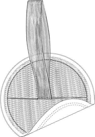 Ventralex mesh in umbilical/epigastric hernia repairs: clinical ...