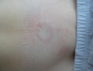 Handlebar hernia: a case report and literature review on traumatic ...