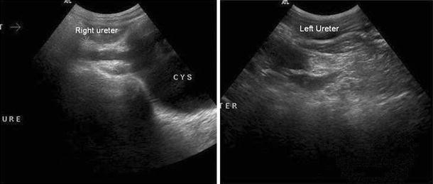 Abdominoscrotal Hydrocele An Insight Into Its Origin Springer For
