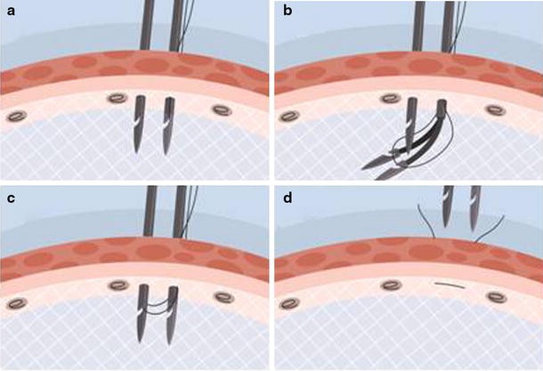 Trans-fascial laparoscopic mesh fixation: a procedural comparison using ...