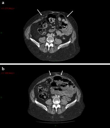 The peritoneal flap hernioplasty for repair of large ventral and ...