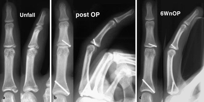 Fingerfrakturen | SpringerLink