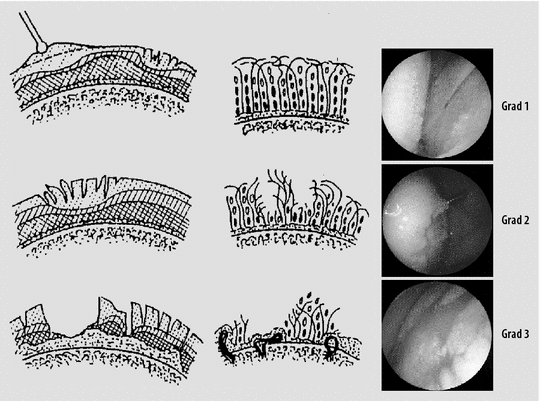 Begutachtung des Knorpelschadens | SpringerLink