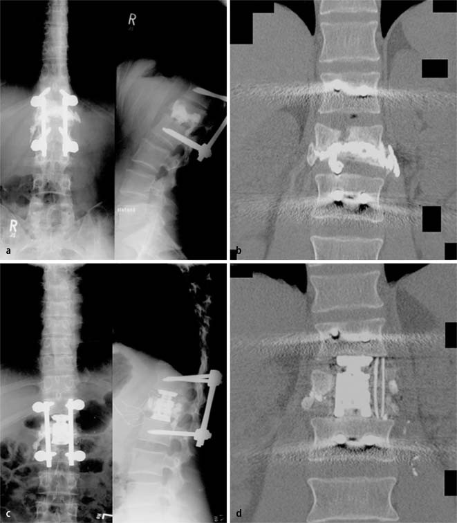 Ventrale Stabilisierung der unteren BWS/LWS | SpringerLink