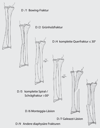 Klassifikationen von Frakturen im Kindesalter | SpringerLink