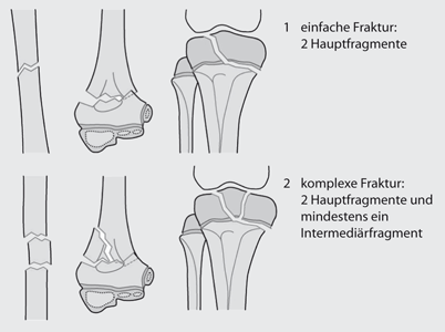 Klassifikationen von Frakturen im Kindesalter | SpringerLink