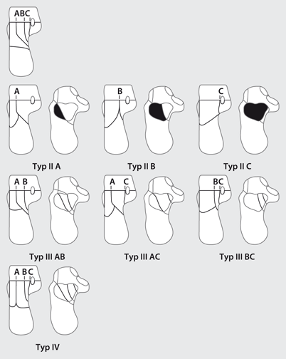 Frakturen des Fersenbeins | SpringerLink