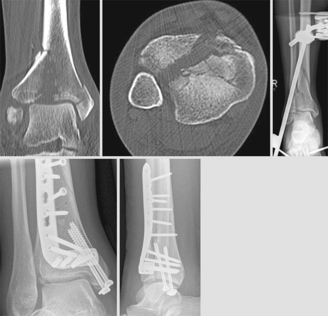 Pilon-tibiale-Frakturen | SpringerLink