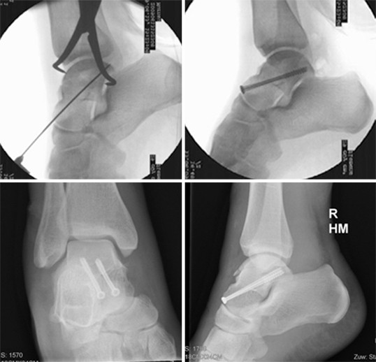 Rückfußfrakturen | SpringerLink