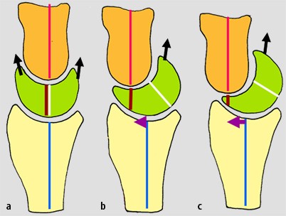 Die verspätet diagnostizierte skapholunäre Bandverletzung | SpringerLink