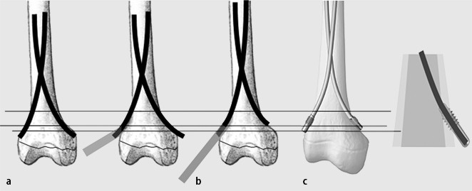 Was tun, wenn die elastisch-stabile intramedulläre Nagelung (ESIN) an ihre Grenzen stößt ...