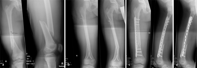 Was tun, wenn die elastisch-stabile intramedulläre Nagelung (ESIN) an ihre Grenzen stößt ...