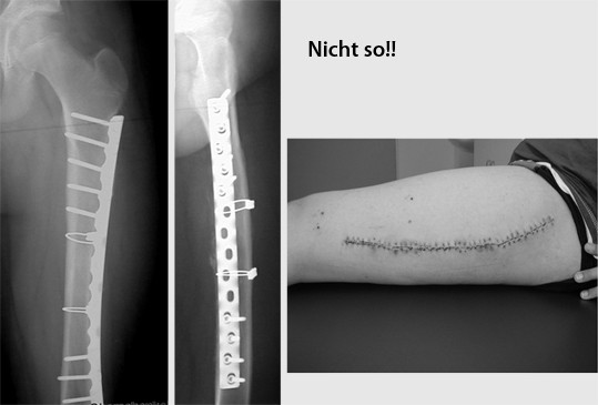 Was tun, wenn die elastisch-stabile intramedulläre Nagelung (ESIN) an ihre Grenzen stößt ...