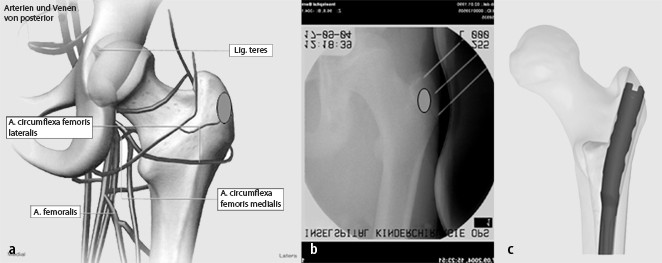 Was tun, wenn die elastisch-stabile intramedulläre Nagelung (ESIN) an ihre Grenzen stößt ...