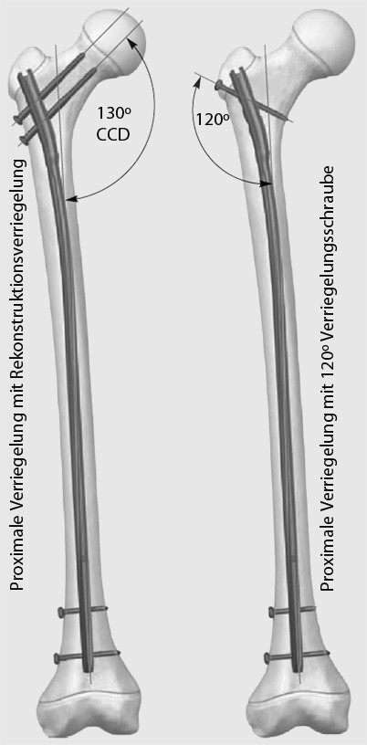 Was tun, wenn die elastisch-stabile intramedulläre Nagelung (ESIN) an ihre Grenzen stößt ...
