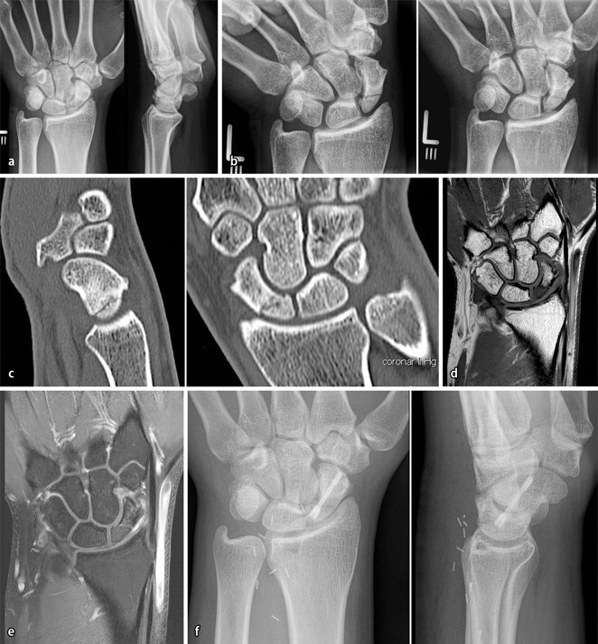 Verletzungen der Handwurzel und deren Spätfolgen | SpringerLink