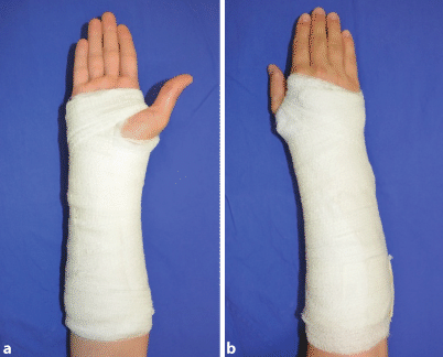 Gipstechniken in der Handchirurgie | SpringerLink