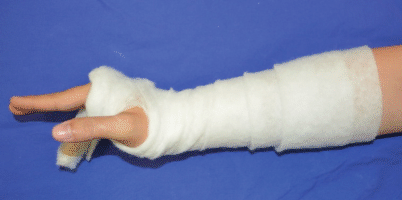 Gipstechniken in der Handchirurgie | SpringerLink