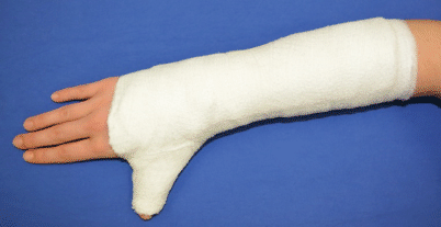 Gipstechniken in der Handchirurgie | SpringerLink