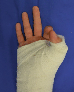 Gipstechniken in der Handchirurgie | SpringerLink