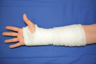 Gipstechniken in der Handchirurgie | SpringerLink