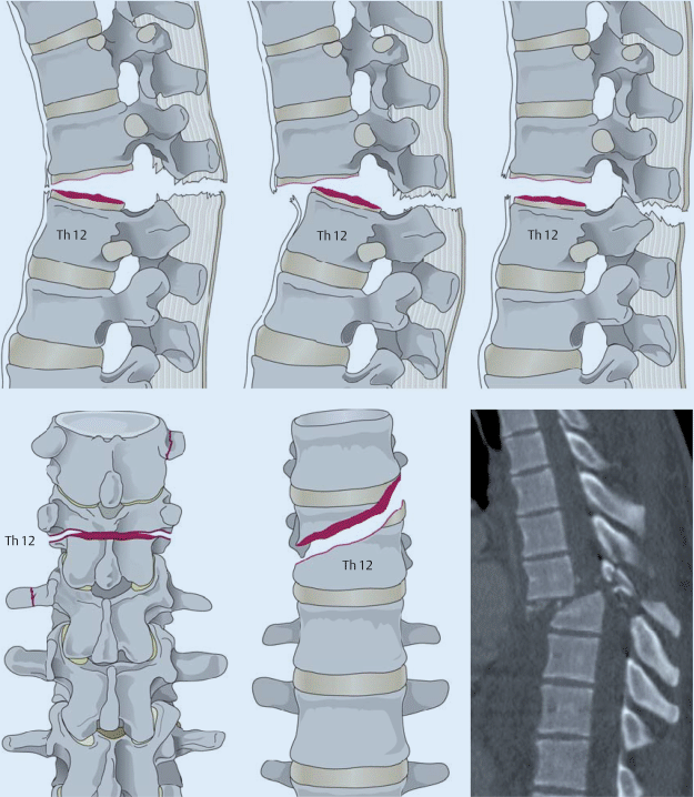 Die neue AOSpine-Klassifikation: Alles einfacher? | SpringerLink