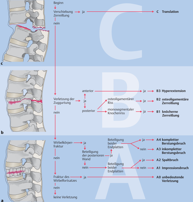 Die neue AOSpine-Klassifikation: Alles einfacher? | SpringerLink